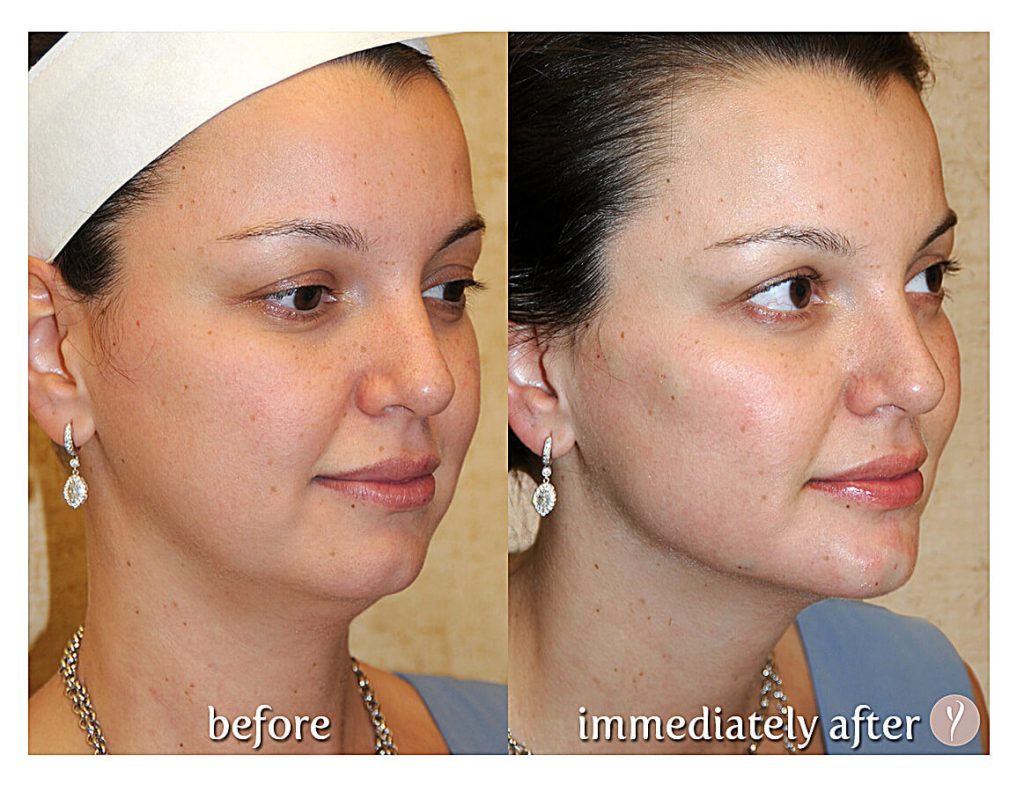 Y Lift Nonsurgical Facelift in Savannah GA | Dr. E. Ronald Finger