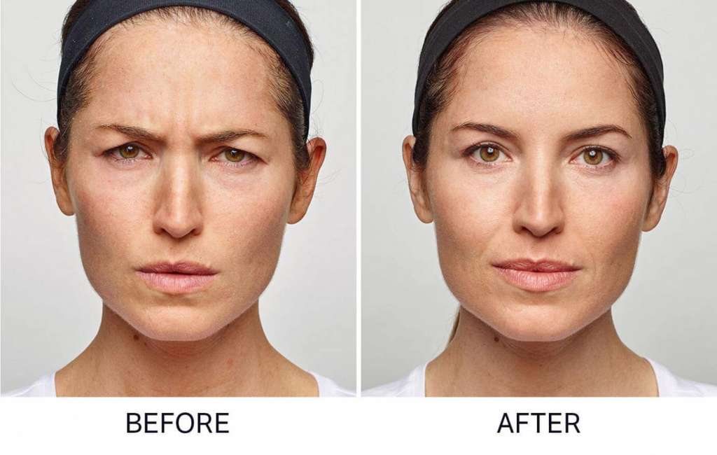 Dysport versus Botox | We offer both | Book Your Treatment in Savannah