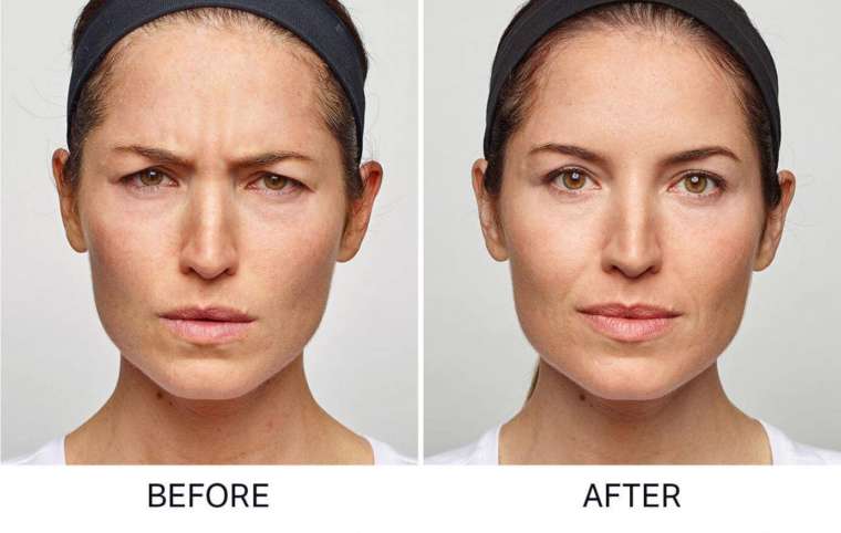 Dysport versus Botox | We offer both | Book Your Treatment in Savannah